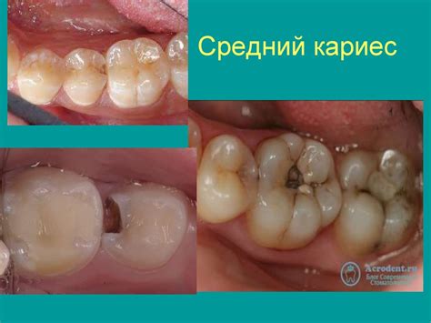 Лечение кариеса презентация онлайн