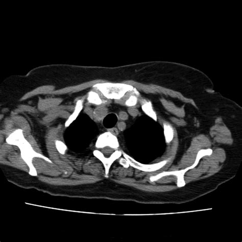 Aortic Arch Pseudoaneurysm Radiopaedia 8534 9368 Axial Non Contrast Nc Commons