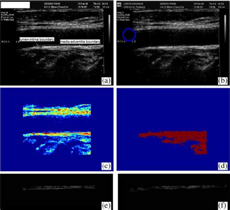 Level Set Segmentation Of Cca Image A Us Image With The Imc Gt Download Scientific Diagram
