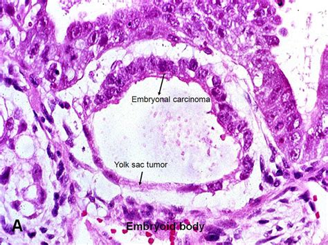 American Urological Association Polyembryoma And Diffuse Embryoma