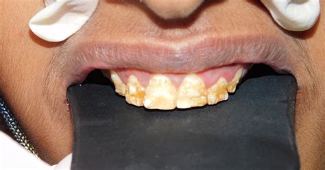 Aesthetic Rehabilitation Of Young Female Patient With Congenital