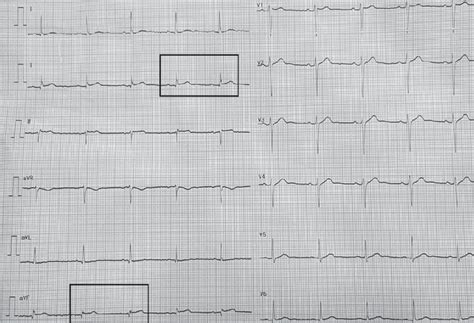 An Example Of Fragmented Qrs On Electrocardiography Download Scientific Diagram