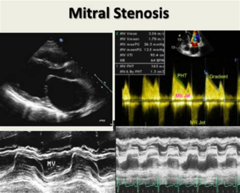 Week 2 Lecture Notes Mitral Stenosis Flashcards Quizlet