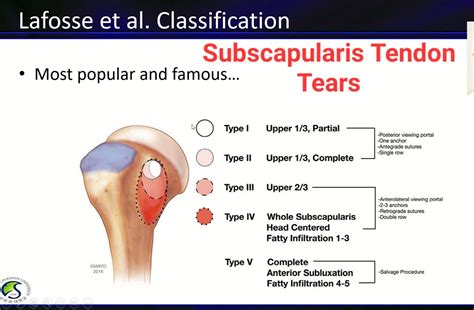 Subscapularis Tendon Tears Tendon Tear Suture Types Subluxation