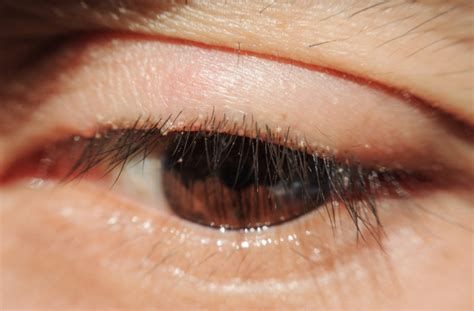 What Happens If Blepharitis Is Left Untreated See And Be Seen Eyecare