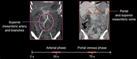 Abdominal Ct Phases • Litfl • Radiology Library