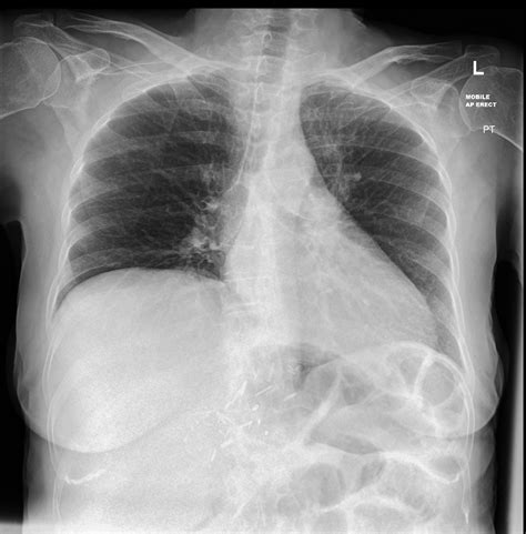 Chest X Ray Findings Of Pneumonia At Paul Nichols Blog