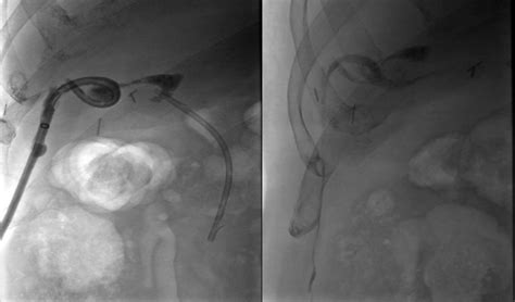 Figure 3 From Endoscopic Approach For Management Of Dropped Gallstones Using Percutaneous