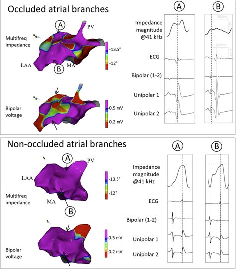 Electroanatomical Voltage And Multifequency Maps And Corresponding Download Scientific Diagram