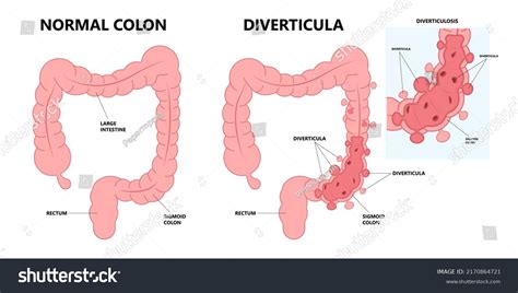 Diverticulosis Sigmoid Colon