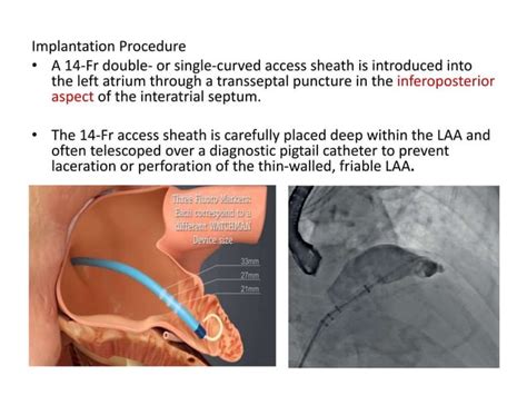 Left Atrial Appendage Closure Pptx
