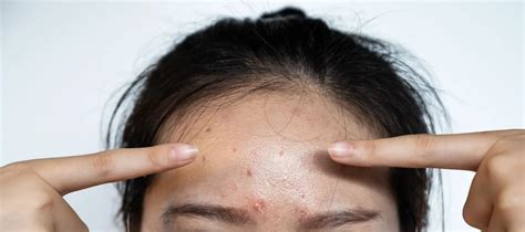 Phytophotodermatitis Symptoms Causes And Effective Treatment The Pink Foundry