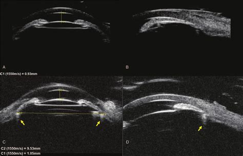 A And B Ubm Showed Ciliary Block On Day 1 After Trabeculectomy C And Download Scientific
