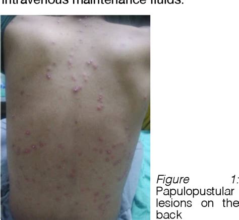 Figure 1 From A Case Of Hla B51 Positive Mucocutaneous Variant Of
