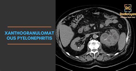 Xanthogranulomatous Pyeloneophritis Radiology Case Radiogyan