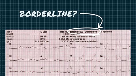 What Does Borderline Ecg Mean For Your Heart Health Lifestyle Net Worth