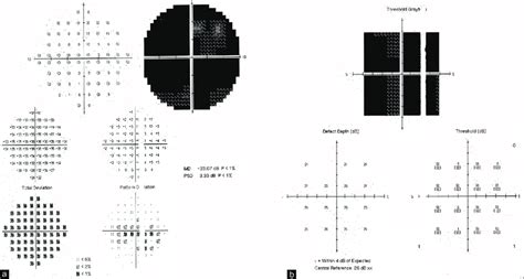A Central 10 2 Hfa Showing Loss Of The Central Visual Field B Download Scientific Diagram