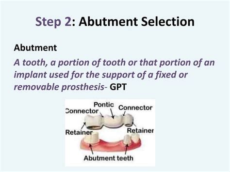 Design Of A Fixed Partial Denture With Abutment Tooth Preparation Ppt