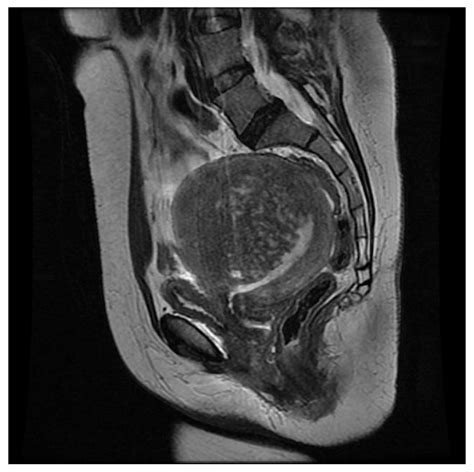 Adenomyosis Mri Junctional Zone Thickness