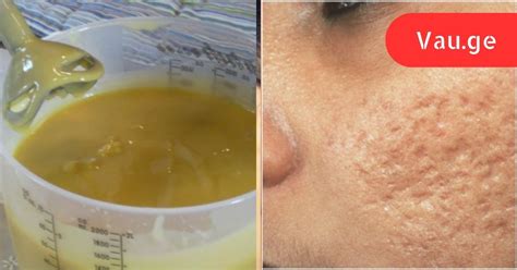 აკნეს ნიშნები ნაწიბურები და ასაკობრივი ლაქები ბუნებრივი სახლის საშუალება ყველაფერს წაშლის