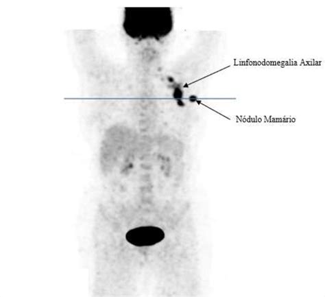 Paciente 2 Maximum Intensity Projection Mpi Download Scientific Diagram
