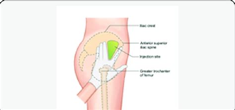 Safe Zone For Intramuscular Injection Download Scientific Diagram
