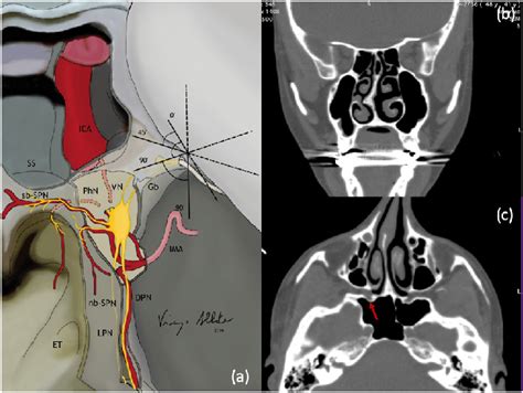 A Anatomical Illustration Of The Spg Vn Vidian Nerve Phn Download Scientific Diagram