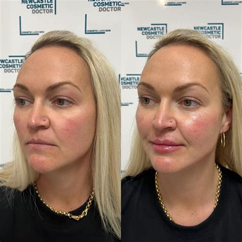 Mid Face Cheek Filler Artofit