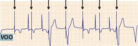Pacemaker Stimulation Modes Nbg Codes Ecg Book