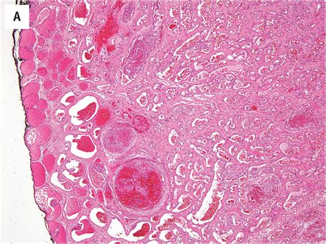 Vascular Tumors Of Soft Tissue And Bone Clinical Tree