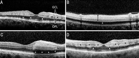 Cross Sectional Sd Oct Scans Of 4 Patients With Acute Retinal Ischemia Download Scientific