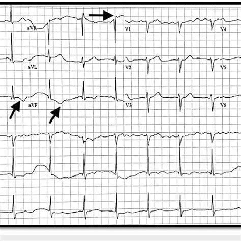Ekg Showing St Elevation Initial Ekg Showing Isolated St Elevation
