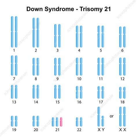 Trisomy 21 Syndrome Illustration Stock Image F0428126 Science Photo Library