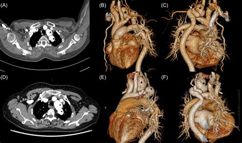 A Enhanced‐contrast Computed Tomography Revealed Multiple Aneurysms Download Scientific