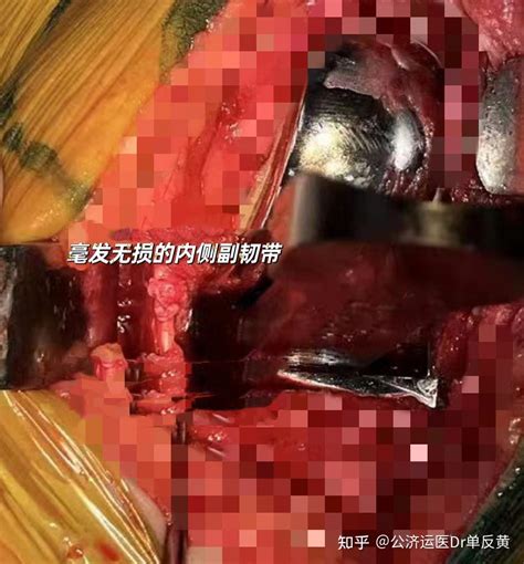 那些确保牛津膝关节单髁置换的术中要点之 知乎