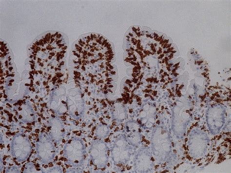 Intraepithelial Lymphocytosis 30 Lymphocytes 100 Enterocytes