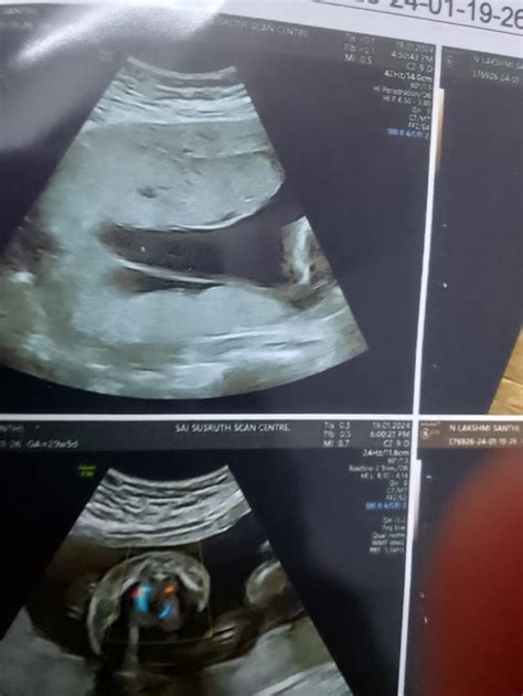 20 Week Scan Twins R Nubtheory