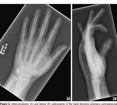 Necrotizing Fasciitis Definition