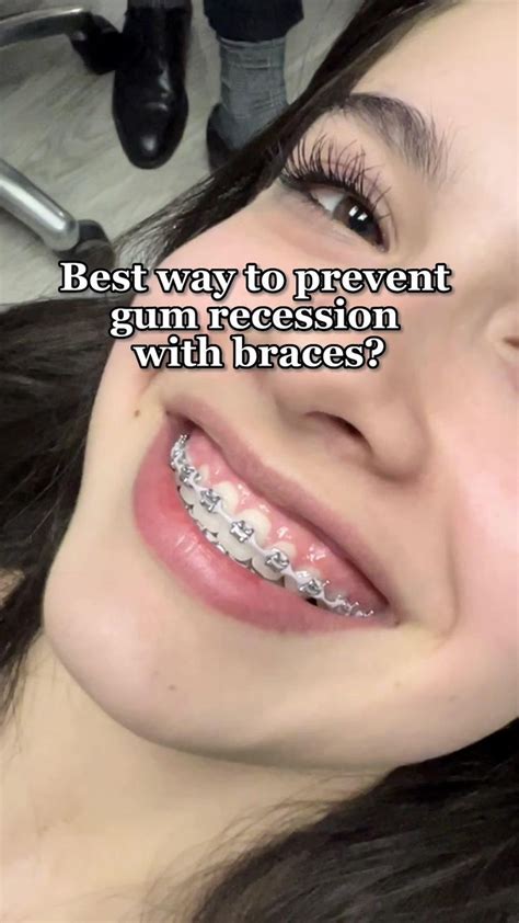 Braces Rubber Bands Braces Rubber Bands Getting Braces Braces Tips
