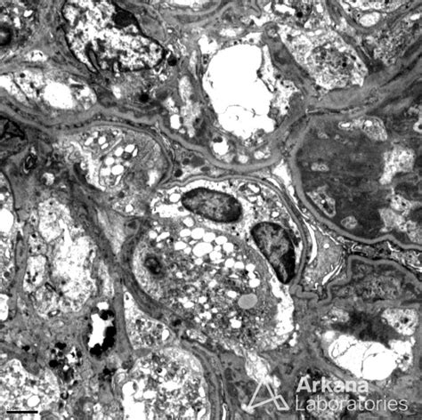 Mesangial And Vague Subendothelial Immune Complex Deposits 2 Ismms Nephrology Fellowship
