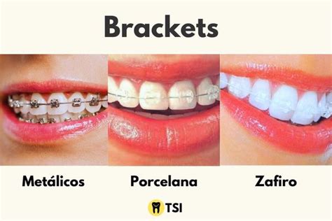 Tipos De Brackets En Odontología Como Funcionan Cuál Elegir En La