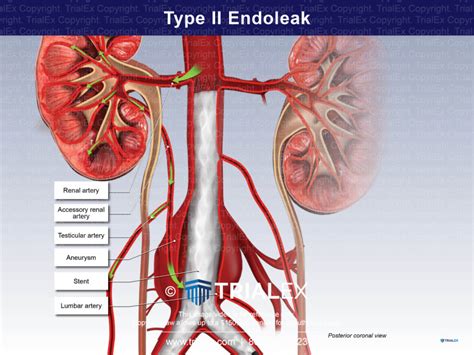 Type 2 Endoleak Trialquest Inc