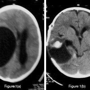 A Pre Operative Unenhanced CT Scan Which Shows A Large CSF Density Download Scientific
