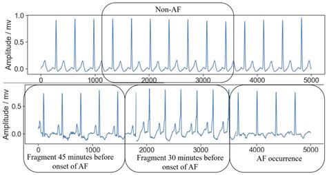 Atrial Fibrillation Prediction Based On Recurrence Plot And Resnet