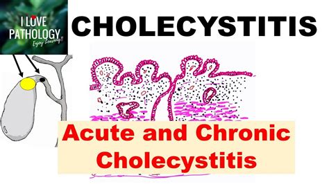 Cholecystitis Acute And Chronic Pathology And Complications Youtube