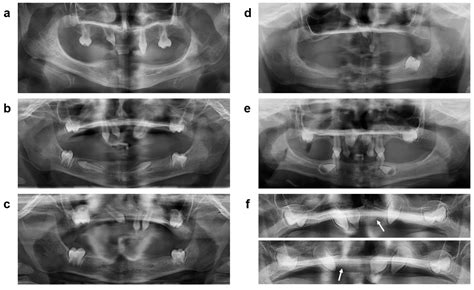 Ijms Free Full Text A Causal Treatment For X Linked Hypohidrotic Ectodermal Dysplasia Long