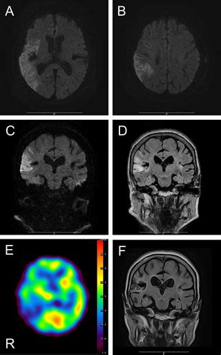 A And B Axial Diffusion Weighted Images Dwis Demonstrated Acute Download Scientific Diagram