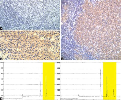 Braf V600e Mutation In Lcs The Monoclonal Antibody Ve1 Is Able To Download Scientific Diagram