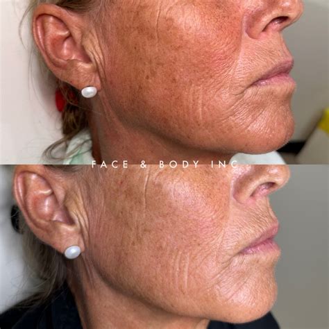 Ipixel Laser Resurfacing Skin Resurfacing Perth Face And Body Inc