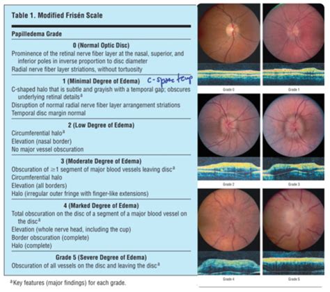 Papilledema Grading